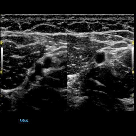 Upper Extremity Venous Anatomy Ultrasound Venous Drainage Of The Upper