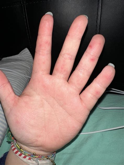 Red Itchy Bumps On Palms And Feet Rmedicaladvice