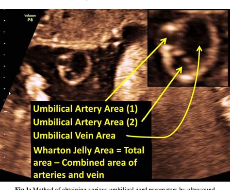 Figure 1 From Critical Evaluation Of Umbilical Cord Morphometry In
