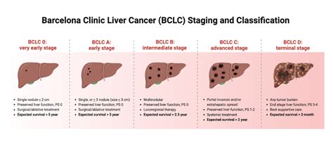 Liver Cancer Stages