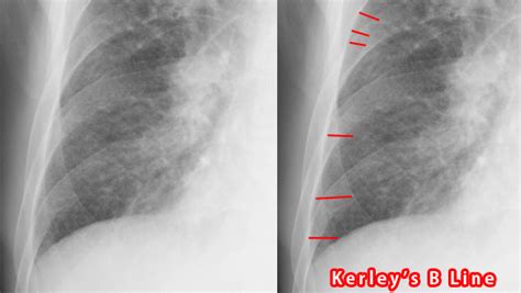 Kerleys B Line等から学ぶ広義間質の肥厚の基礎と疾患のついて 読影を中心にradiographica 診療放射線技師のバイブル