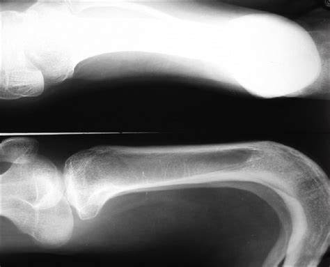 Posterior Anterior And Lateral Leg Showed Bowing Of Tibia And Fibula