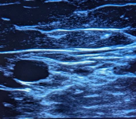 Ultrasound Guided Iv Insertion Tips And Tricks From An Er Nurse Hubpages