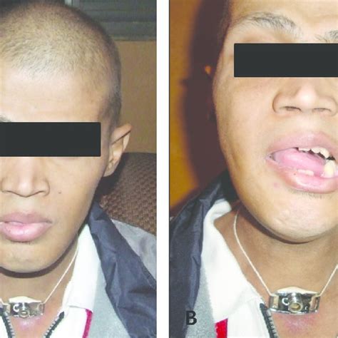 Pdf Retraction Burkitts Lymphoma Clinic Progression And Prognosis