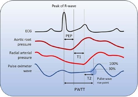 Estimated Continuous Cardiac Output Based On Pulse Wave Transit Time In