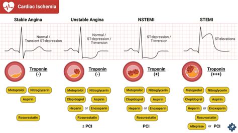 Ischemia Types And Drugs Audio Genially