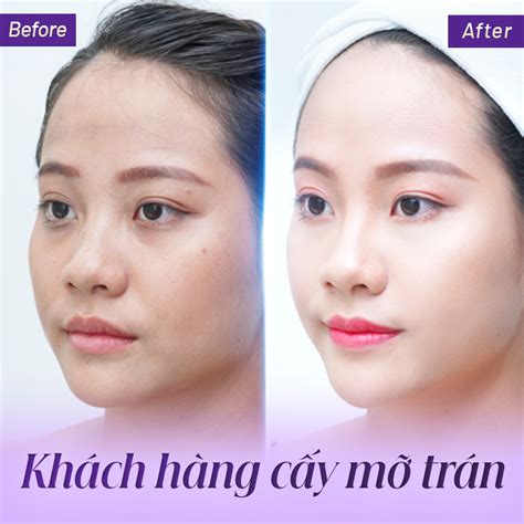 Cấy Mỡ Trán Bí Quyết Sở Hữu Trán đầy đặn Cao Sang