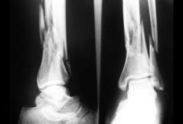 Comminuted Fracture Healing Time Symptoms Treatment Causes