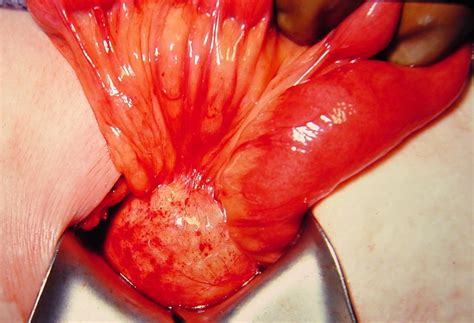 Omentum And Mesentery Surgery Photos