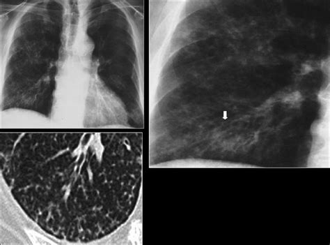 Bacterial Bronchiolitis Chest X Ray Of A 36 Year Old Human Download Scientific Diagram