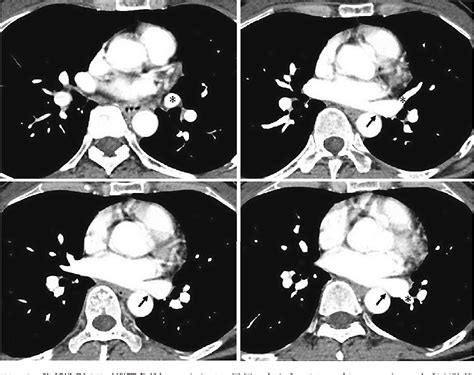 Figure 1 From Thoracoscopic Left Lower Lobectomy For Pulmonary Malt Lymphoma In A Patient With A