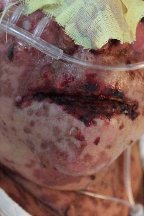 Extensive And Confluent Hemorrhagic Mucositis Of The Lip Mucosa