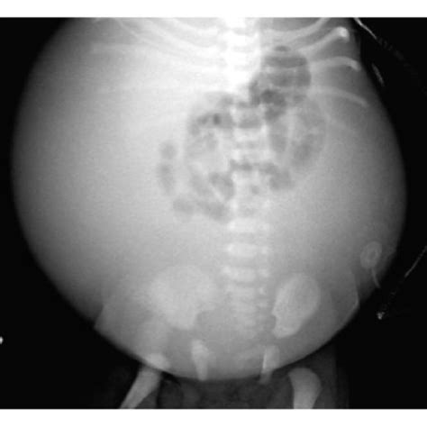 Neonate Soon After Birth Physical Exam Suggestive Of Massive Ascites Download Scientific Diagram