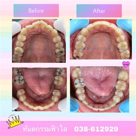 Blog จัดฟัน ที่ไหนดี ระยอง คลินิกทันตกรรมฟ้าใส ดูแลทุกรอยยิ้ม