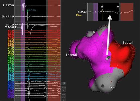Typical Atrial Flutter Mapping And Ablation Cardiac Electrophysiology Clinics