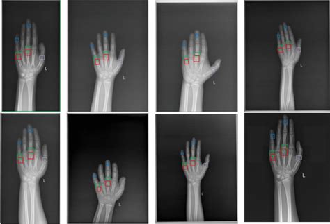 Samples Of Annotations Of The 3rd Metacarpal And 5th Metacarpal Red Download Scientific