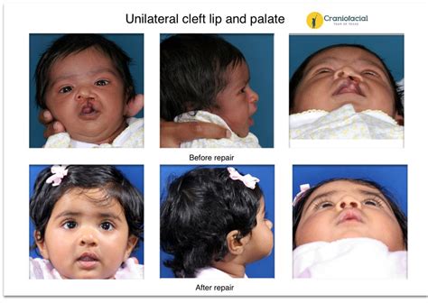 Unilateral Cleft Lip And Palate
