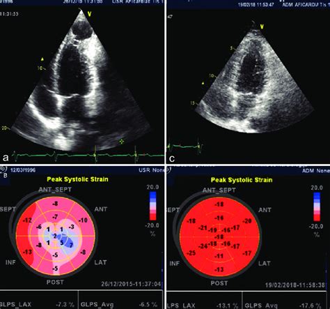 A Four Chamber View Of Transthoracic Echocardiogram Demonstrating Download Scientific Diagram