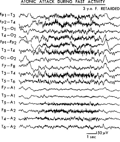Figure I From Significance Of Focal And Lateralized Beta Activity In The Eeg Semantic Scholar
