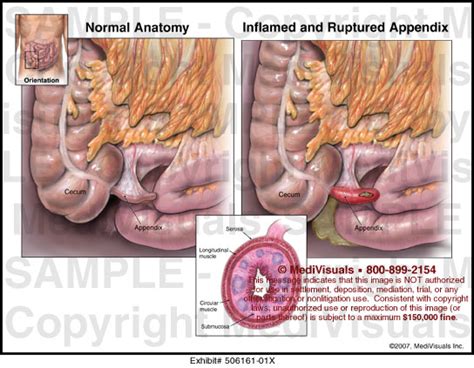 Normal Appendix Vs Inflamed And Ruptured Appendix