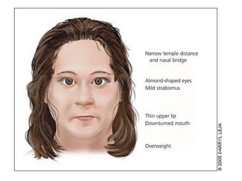 Karyotypes And Dysmorphic Features Ppt