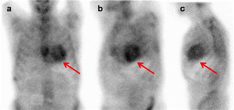 99mtc Pyp Scintigraphic Diagnosis Of Cardiac Amyloidosis In A Patient