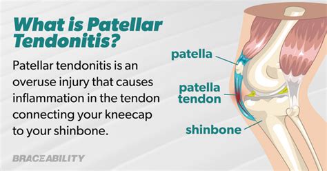 Patellar Tendonitis Pain