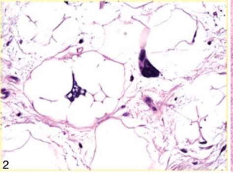Soft Tissue Ihc Update Luis Perez Casanova