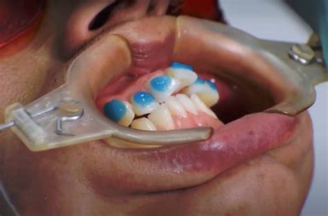 Teeth With Long Roots All You Need To Know