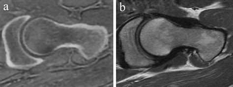 Zero Echo Time Zte Versus Proton Density Weighted Images Swiss Axial Download Scientific