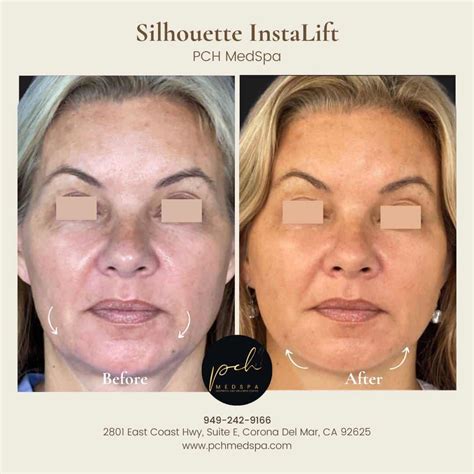 Silhouette Instalift Vs Pdo Thread Lift Which Is Better