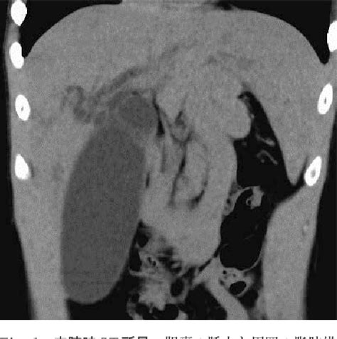 Figure 1 From A Case Of Absence Of The Common Hepatic Duct Presented With Cholelithiasis