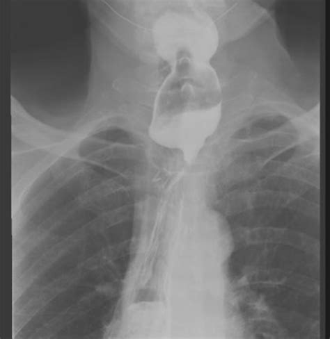 Polip Plat Elevat Lst Ng Colon Descendent Gastrocloud