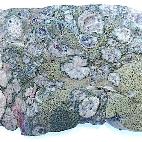 Hepatic Angiosarcoma Macroscopical Features Download Scientific Diagram