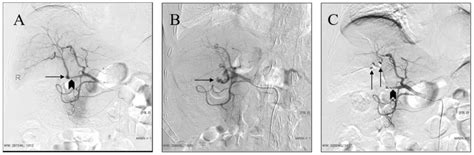 Application Of Interventional Embolization In The Treatment Of Iatrogenic Pseudoaneurysms