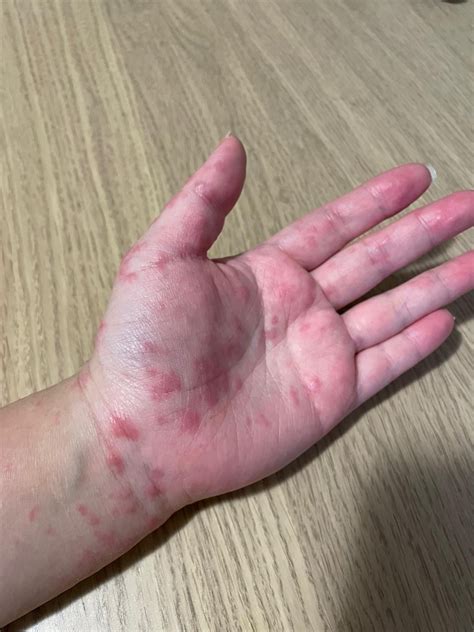 What Is This Please Help R Dermatologyquestions