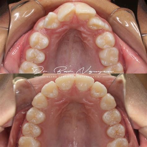 Nonextraction Rpe Airwayorthodontics Beforeandafter Dr Bar The Braces Doc
