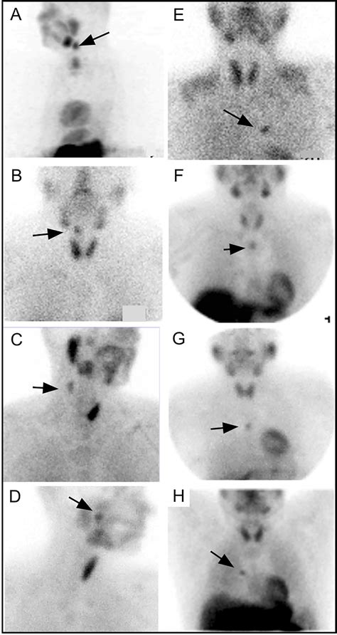Parathyroid Nodules
