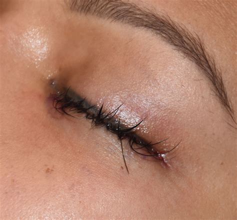 Technical Strategies The Placement Of Alloderm Grafts In Love Band