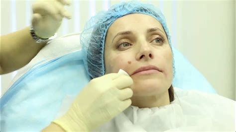 Плазмофиллеры - YouTube