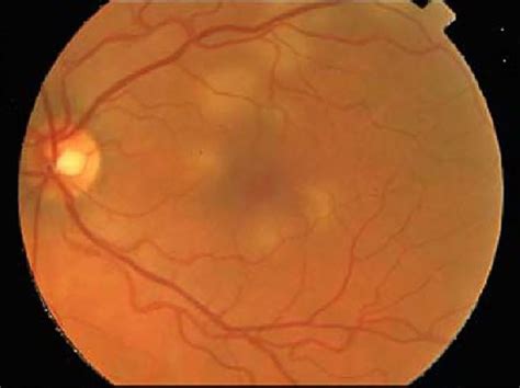 Relentless Ampiginous Placoid Chorioretinitis Clinical Tree