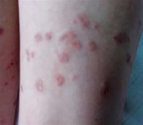 Granuloma Annulare Like Lesions On The Flexor Surface Of The Right