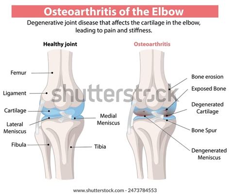 Best Elbow Joint Comparison Royalty Free Images Stock Photos Pictures Shutterstock