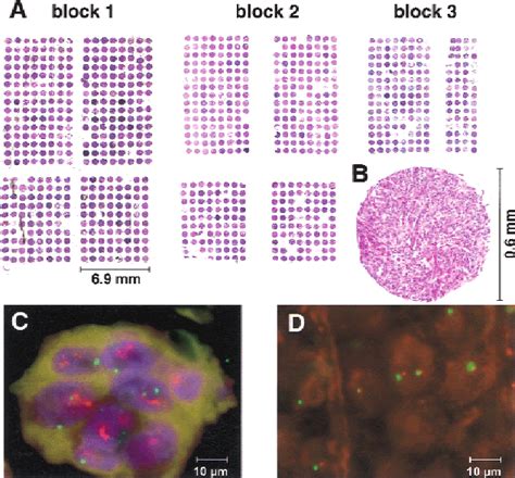 Breast Cancer Tissue Microarrays Tmas Panel A One Complete Set Of Download Scientific