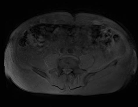 Cholangiocarcinoma Radiopaedia 49009 54157 Axial T1 Nc Commons
