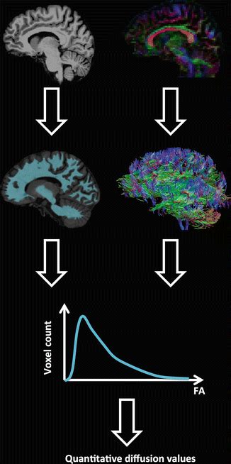 Strategies And Challenges In Dti Analysis Radiology Key
