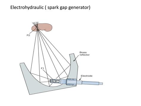 PPT LITHOTRIPTER ENERGY SOURCE PowerPoint Presentation Free Download ID 3619386
