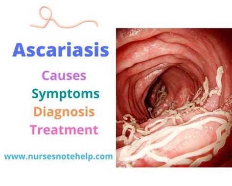 Ascariasis Symptoms