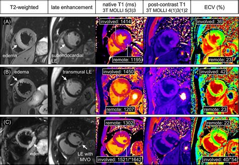 Cardiac Magnetic Resonance T1 Mapping Part 2 Diagnostic Potential And Applications European