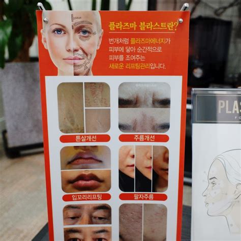부천 뷰티바이미 쌍커풀 흉터 플라즈마 블라스트 후기 네이버 블로그